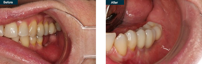 Before & After | NYC Dental Implants | Manhattan NY