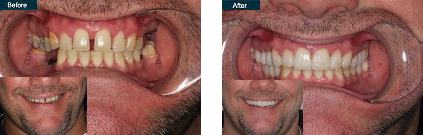Before & After | NYC Dental Implants | Manhattan NY