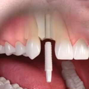 NYC Dental Implants Center | Manhattan Implant Dentists