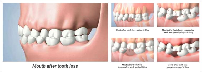 Missing Single Tooth | NYC Dental Implants | Manhattan NY
