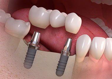 Multiple Teeth Implants in UES, NYC | Multiple Tooth Replacements