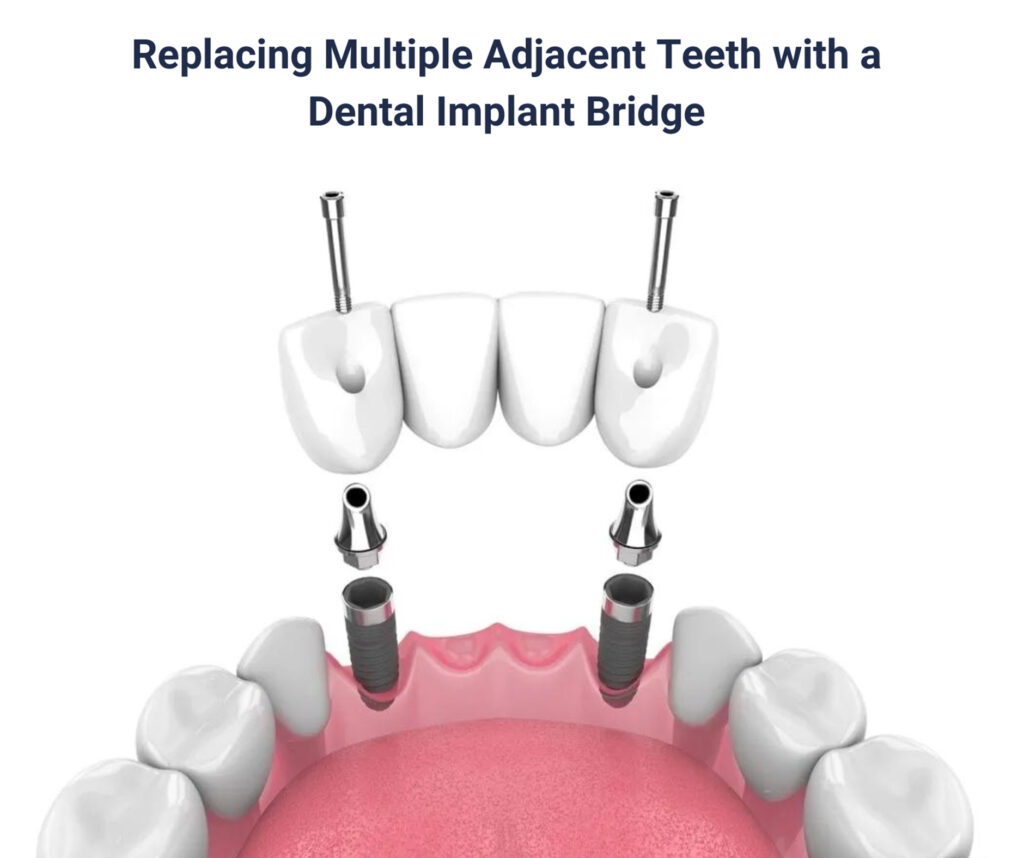 Three Dental Implant Types: Which is Right for You?