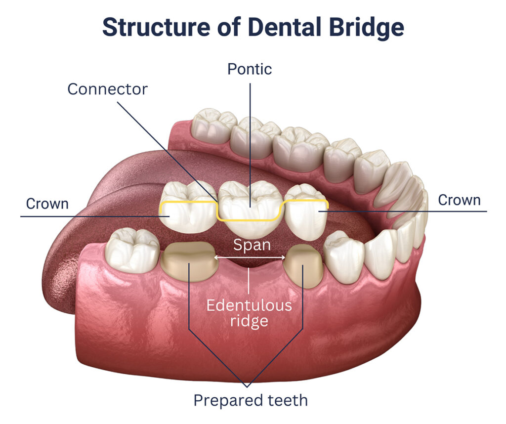 Dental Implants vs Bridges: Finding What’s Best for You
