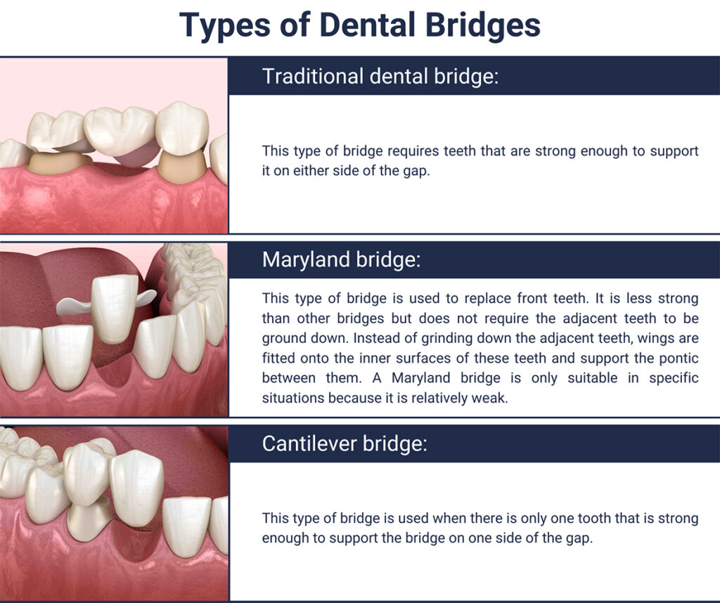 Dental Implants vs Bridges: Finding What’s Best for You