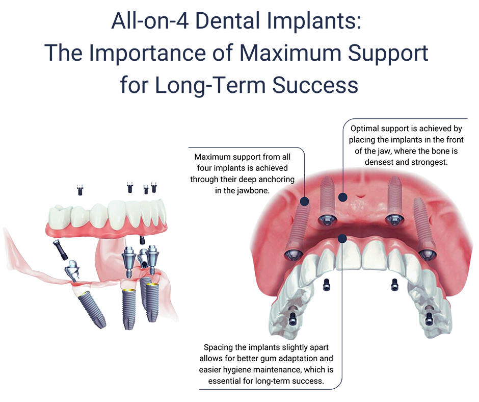 All-on-4 Dental Implants NYC | Implant Dentures Midtown Manhattan & UES