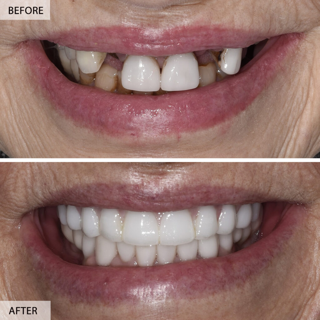 Dental Implants Before & After Images - 60 Galleries