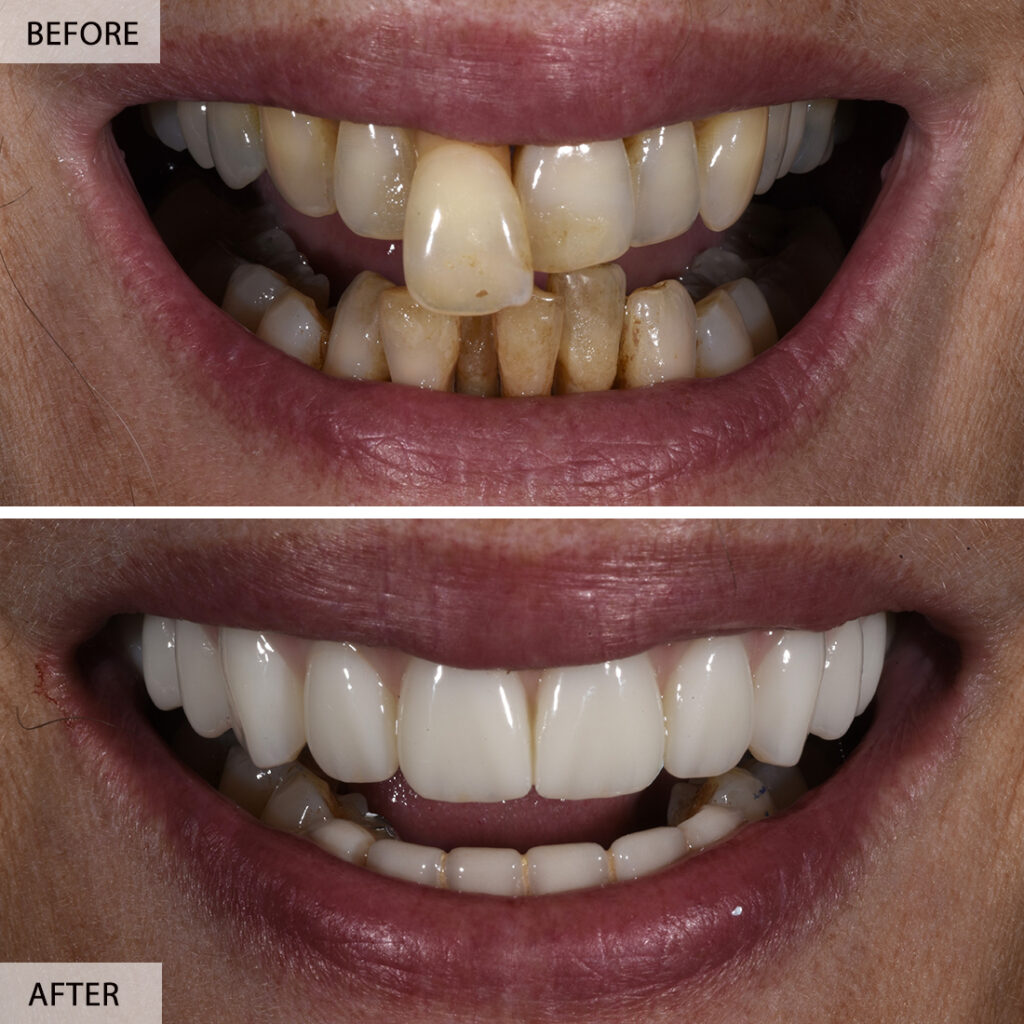 Dental Implants Before & After Images - 60 Galleries