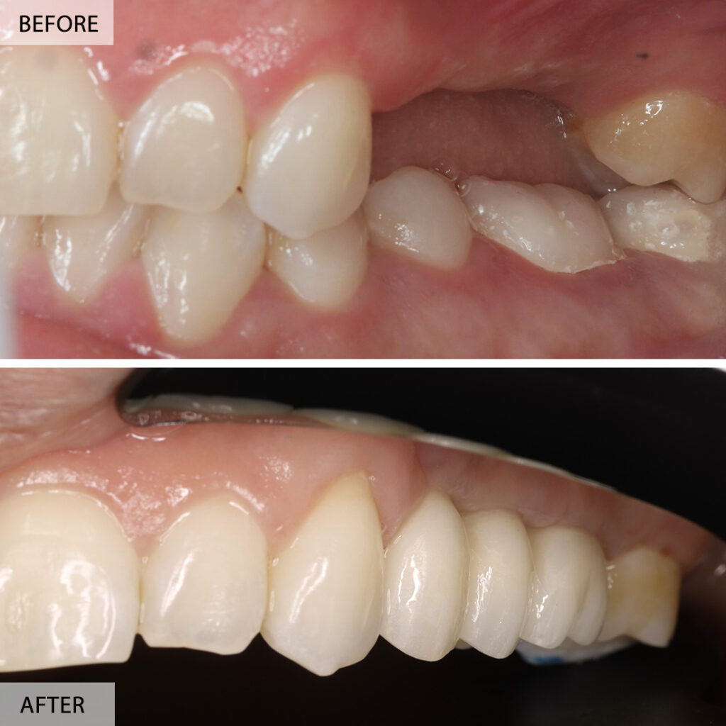 Dental Implants Before & After Images - 60 Galleries