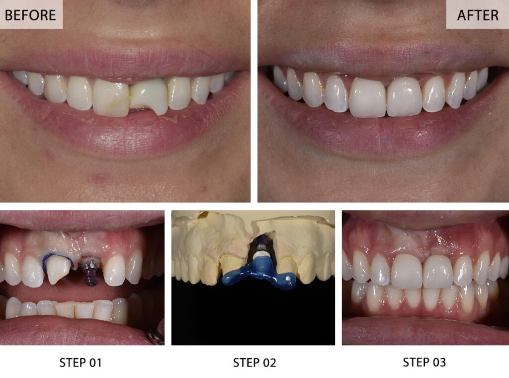 Front Tooth Dental Implants: Before and After Images (17 Galleries)