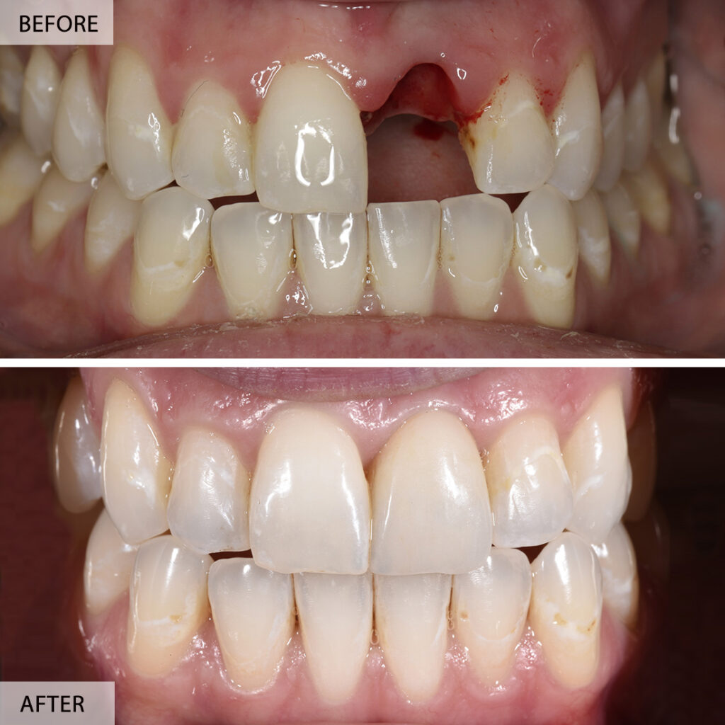 Dental Implants Before & After Images - 60 Galleries