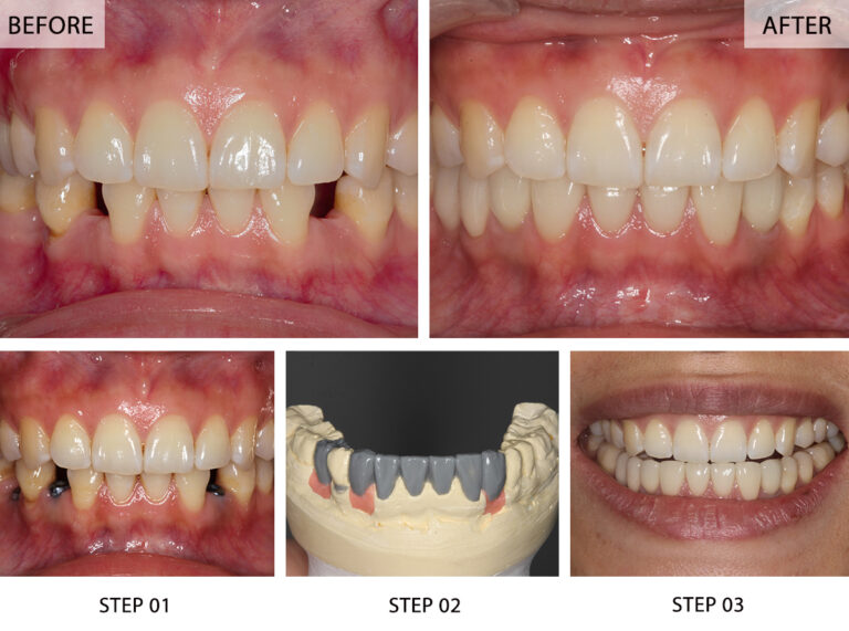 Front Tooth Dental Implants: Before and After Images (17 Galleries)