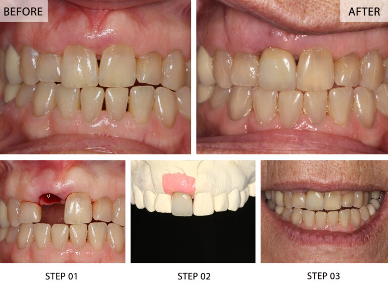 Front Tooth Dental Implants: Before and After Images (17 Galleries)