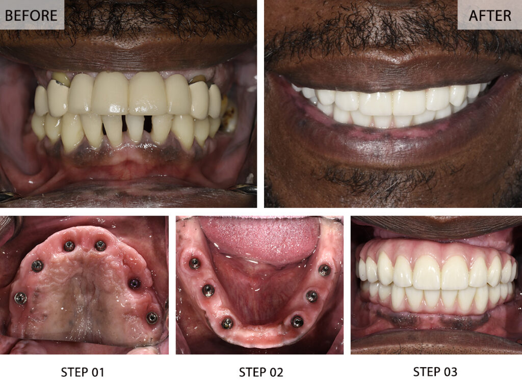 Full Mouth Dental Implants: Before and After Images (6 Galleries)