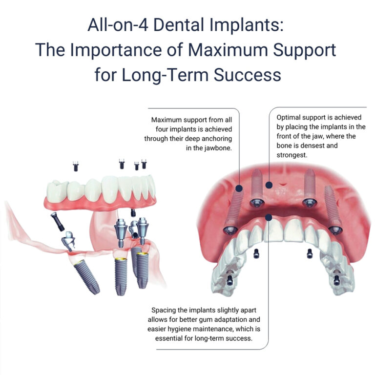All-on-4 Dental Implants NYC | Implant Dentures Midtown Manhattan & UES